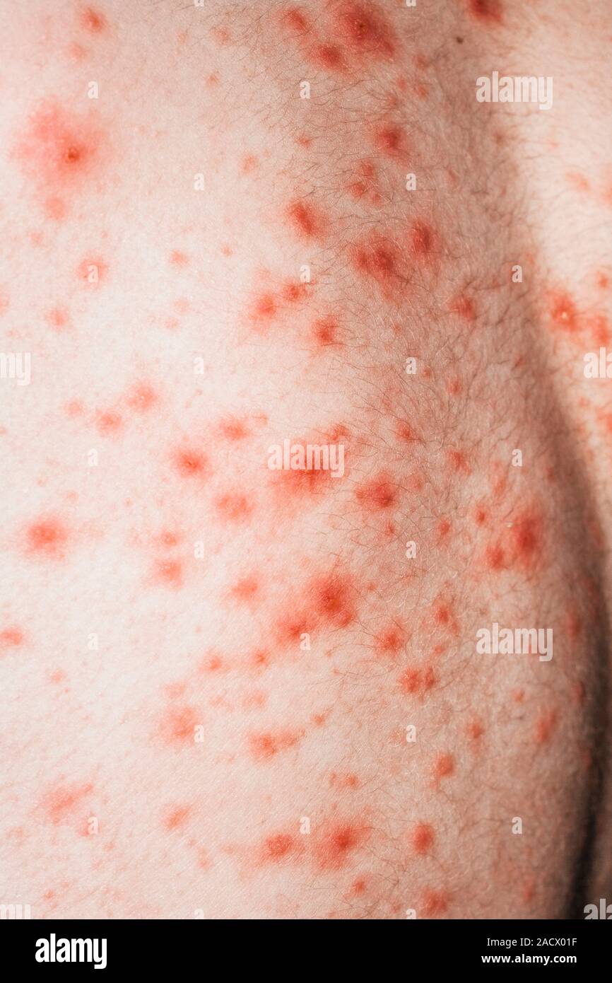 Chickenpox blisters on an eight year old boy's skin. Chickenpox, or ...