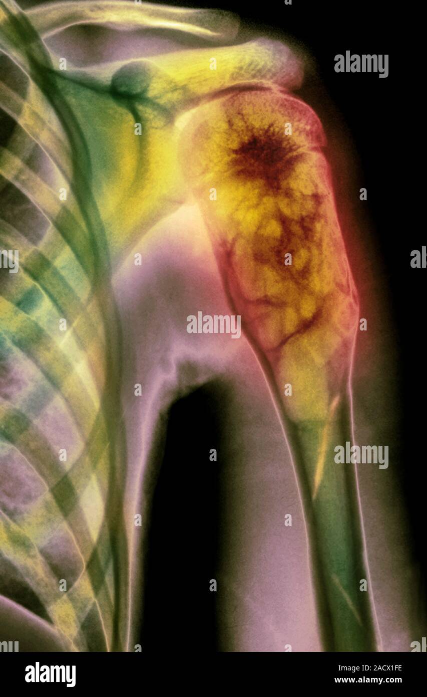 Coloured X-ray in front view of the left humerus (upper arm bone) of a ...