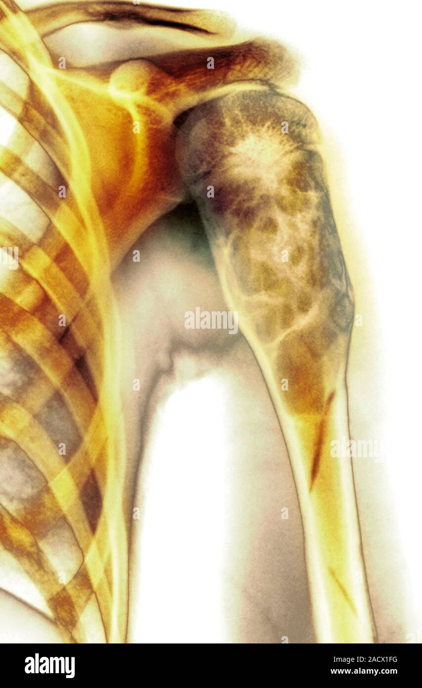 Coloured X-ray in front view of the left humerus (upper arm bone) of a ...