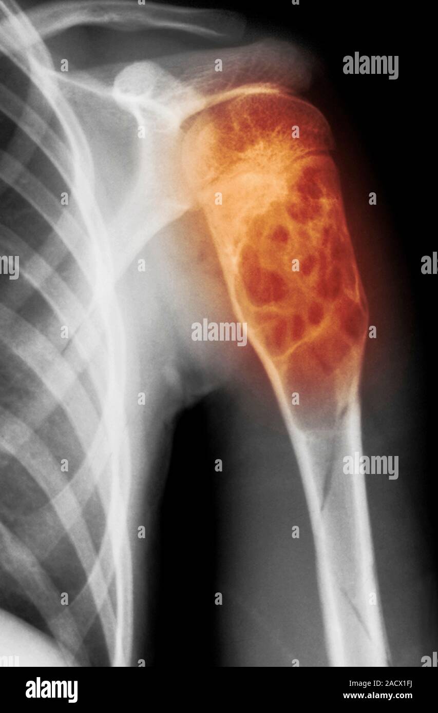 Coloured X-ray in front view of the left humerus (upper arm bone) of a ...
