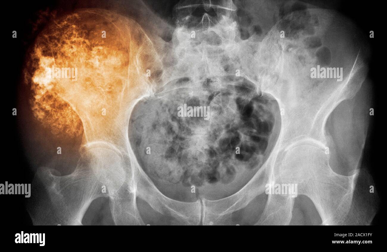 Coloured X-ray in front view of the pelvis of a patient showing a ...