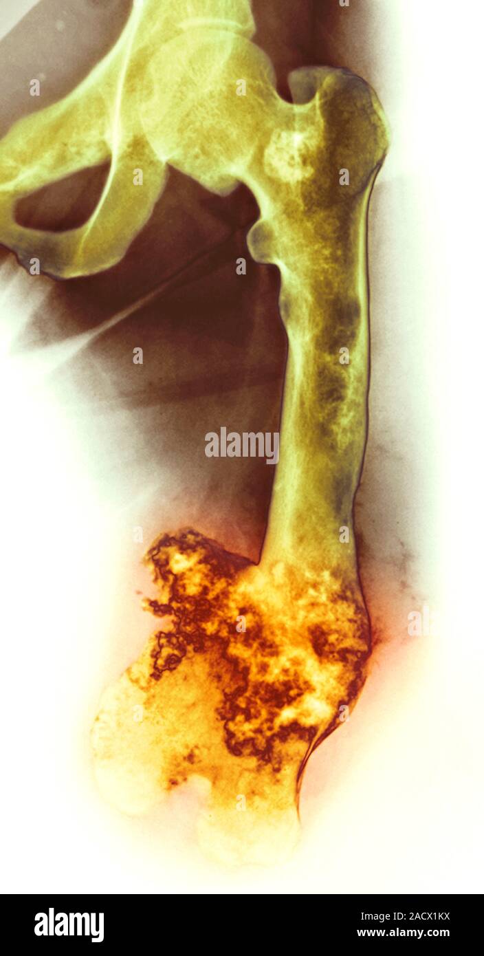 Coloured X-ray in front view of the left femur of a patient showing ...