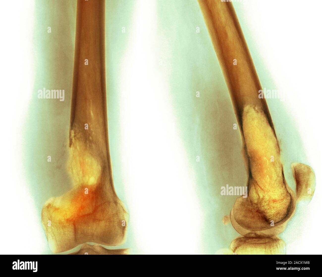 Coloured X-ray in front view (left) and side view (right) of a patient ...
