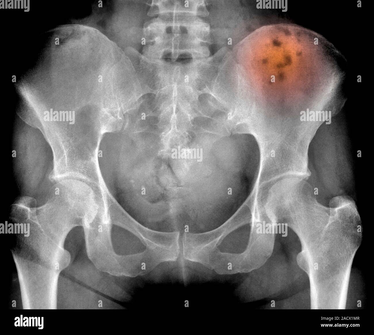 Coloured X-ray in front view of a patient's pelvis showing myeloma ...