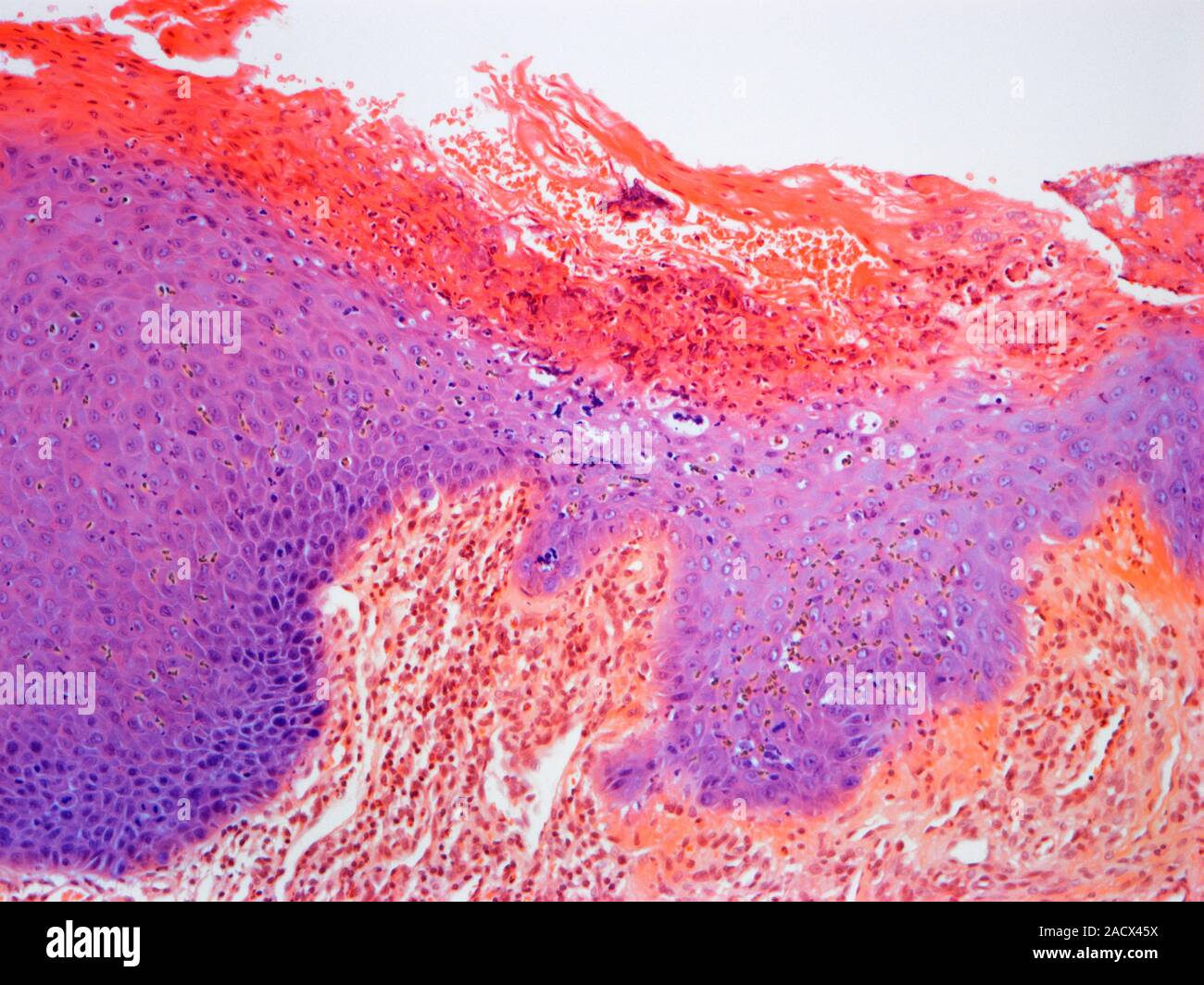 Section of the tongue with thrush, light micrograph. Oral thrush is a ...