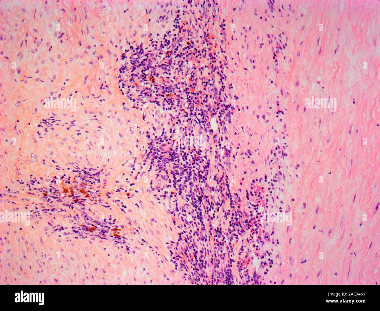 Takayasu's arteritis. Light micrograph of a section through the aorta ...