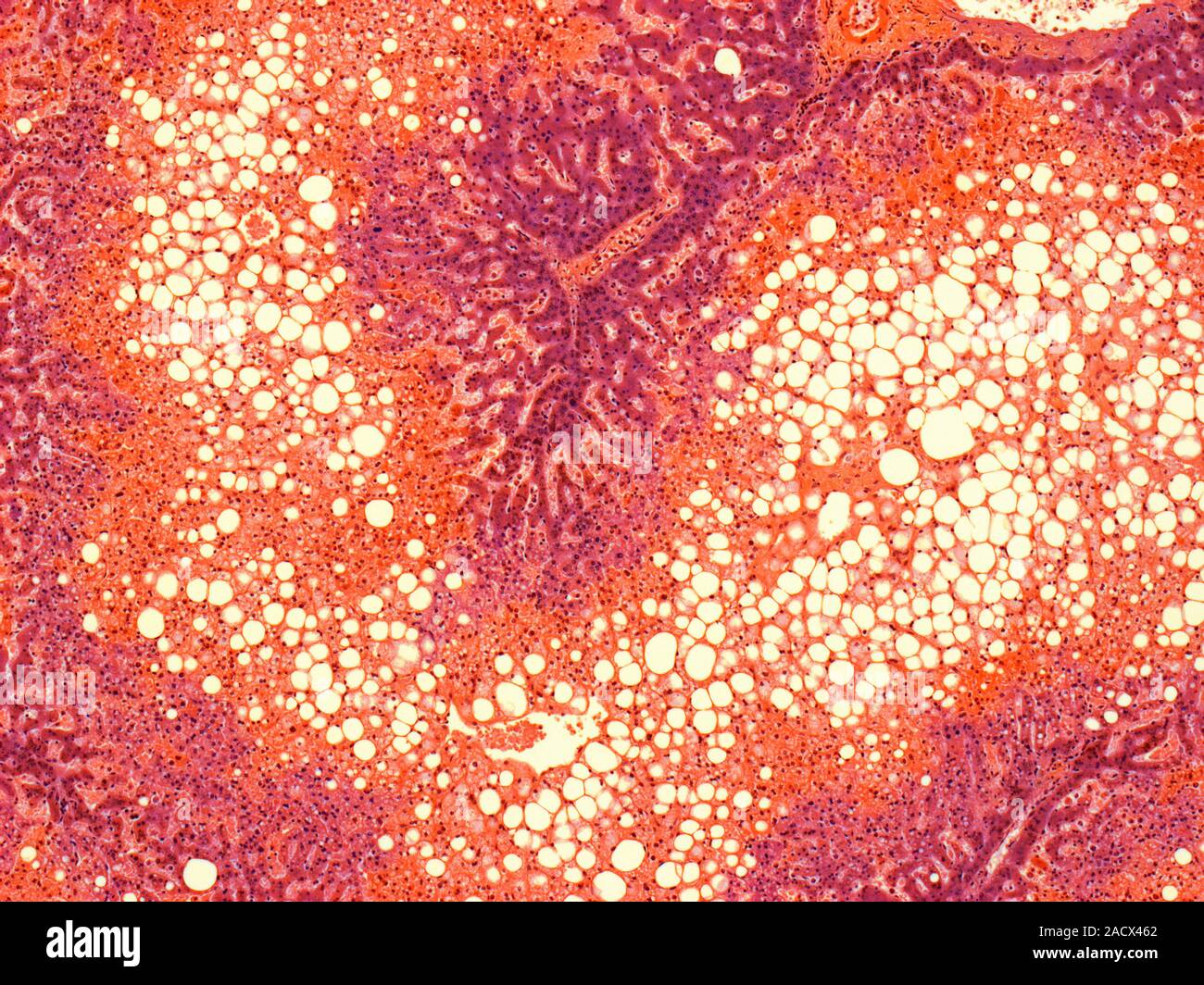 Fatty liver. Light micrograph of a section through the liver of a ...
