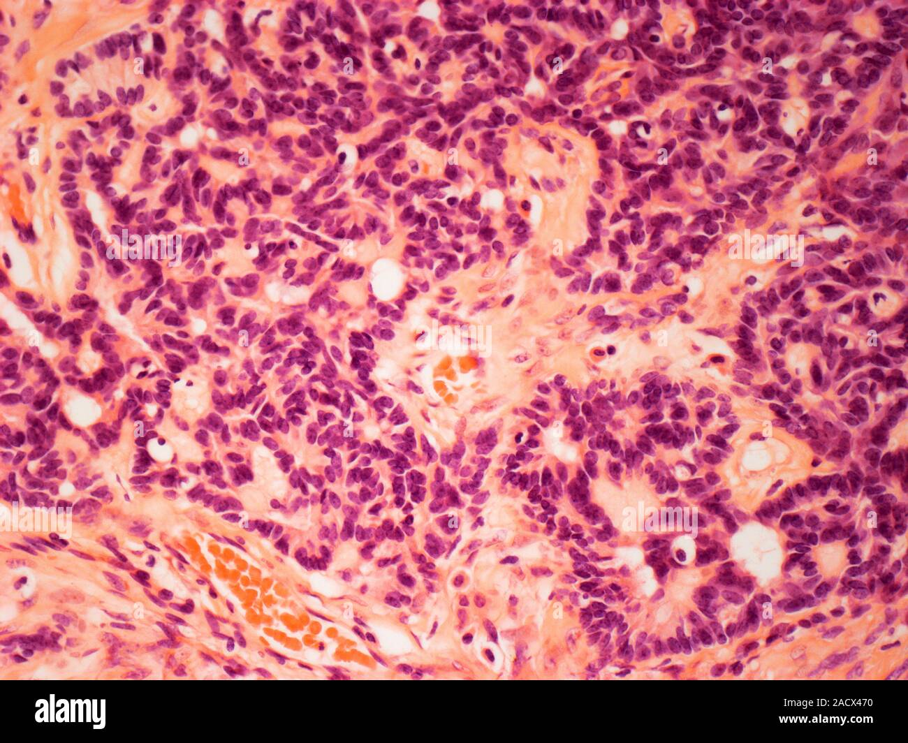 Ovarian tumour. Light micrograph of a wolffian adnexal tumour. Female ...