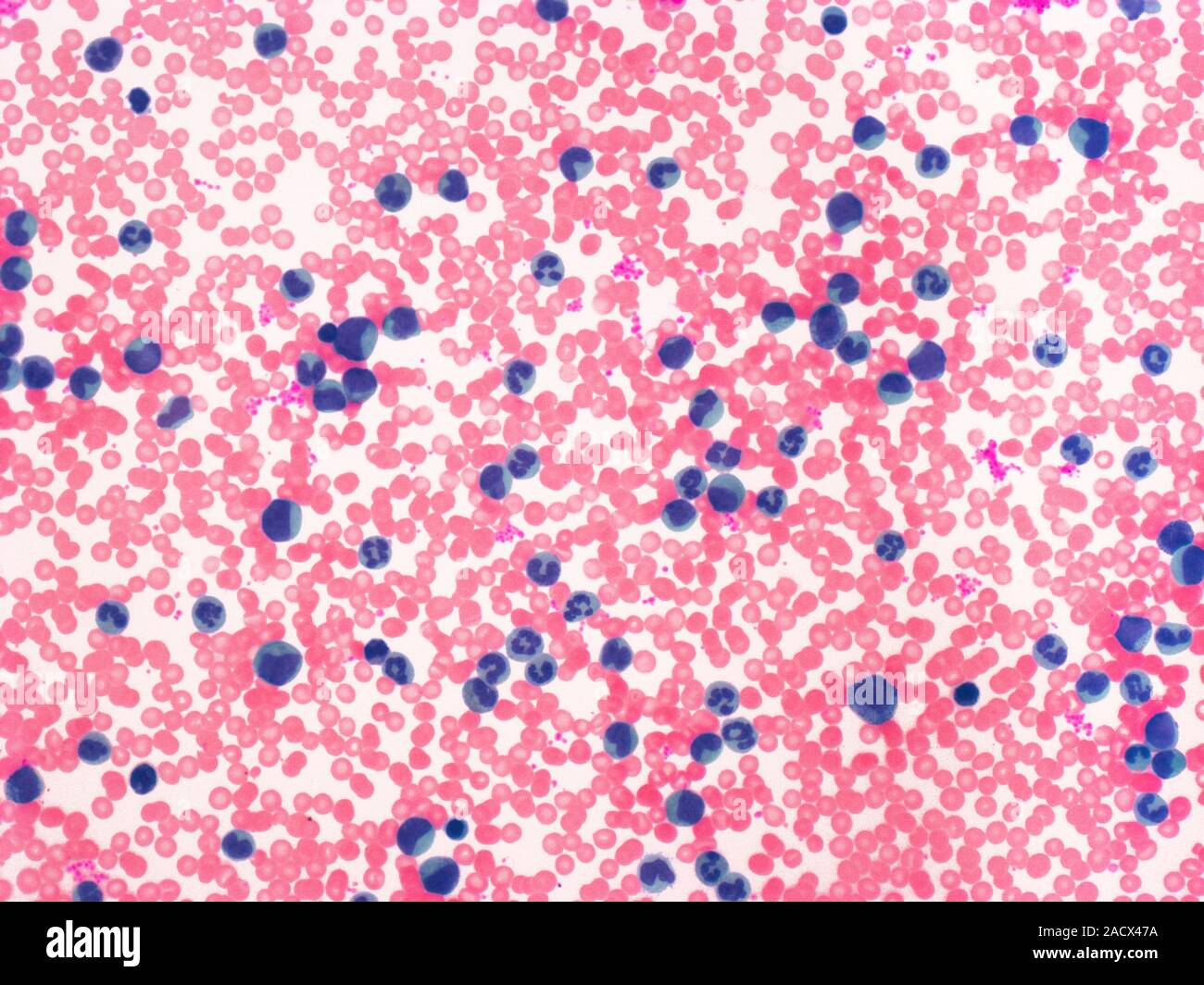 Light micrograph of a blood smear from a patient with chronic myeloid ...