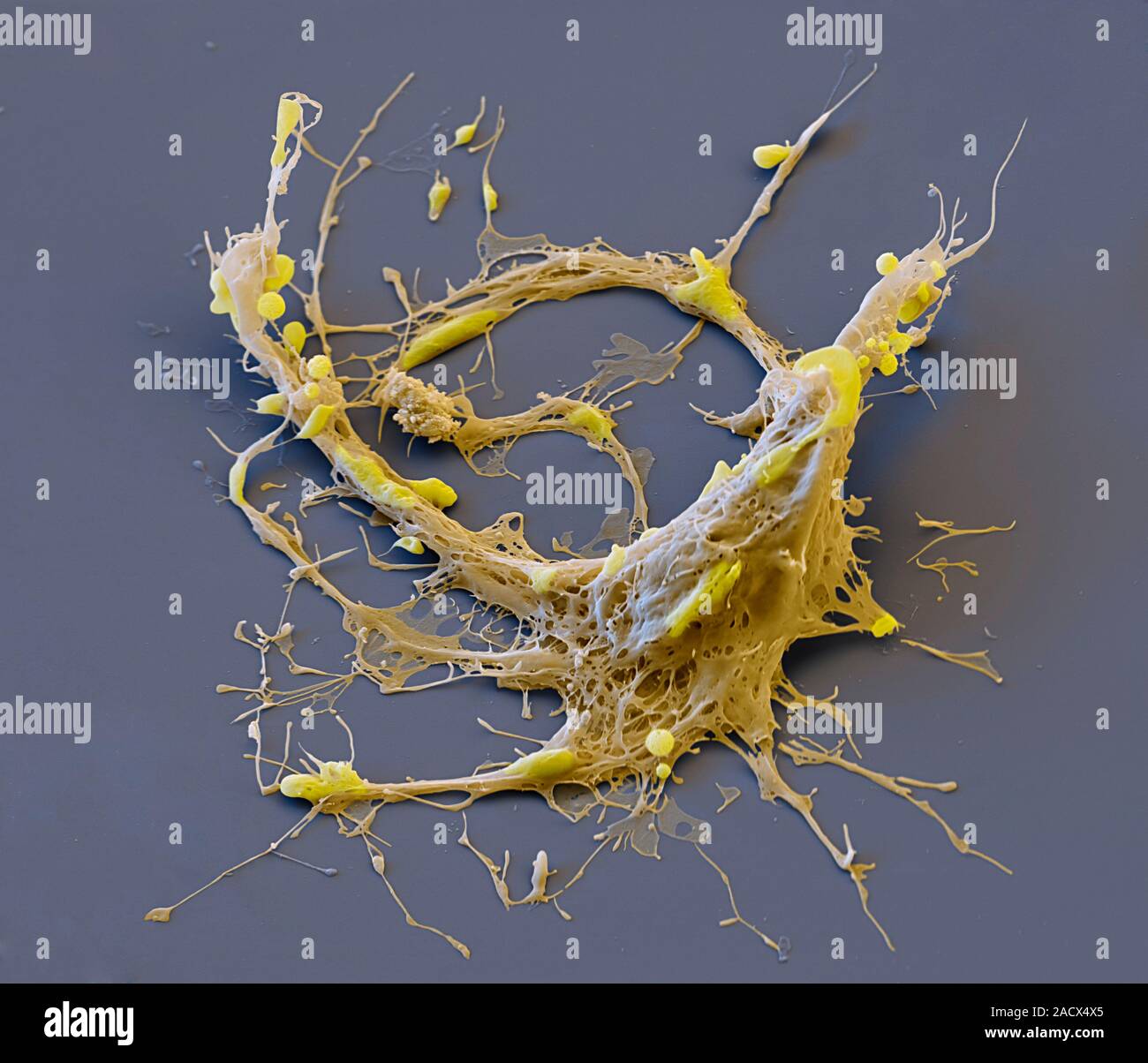 Apoptosis. Coloured scanning electron micrograph (SEM) of an ...
