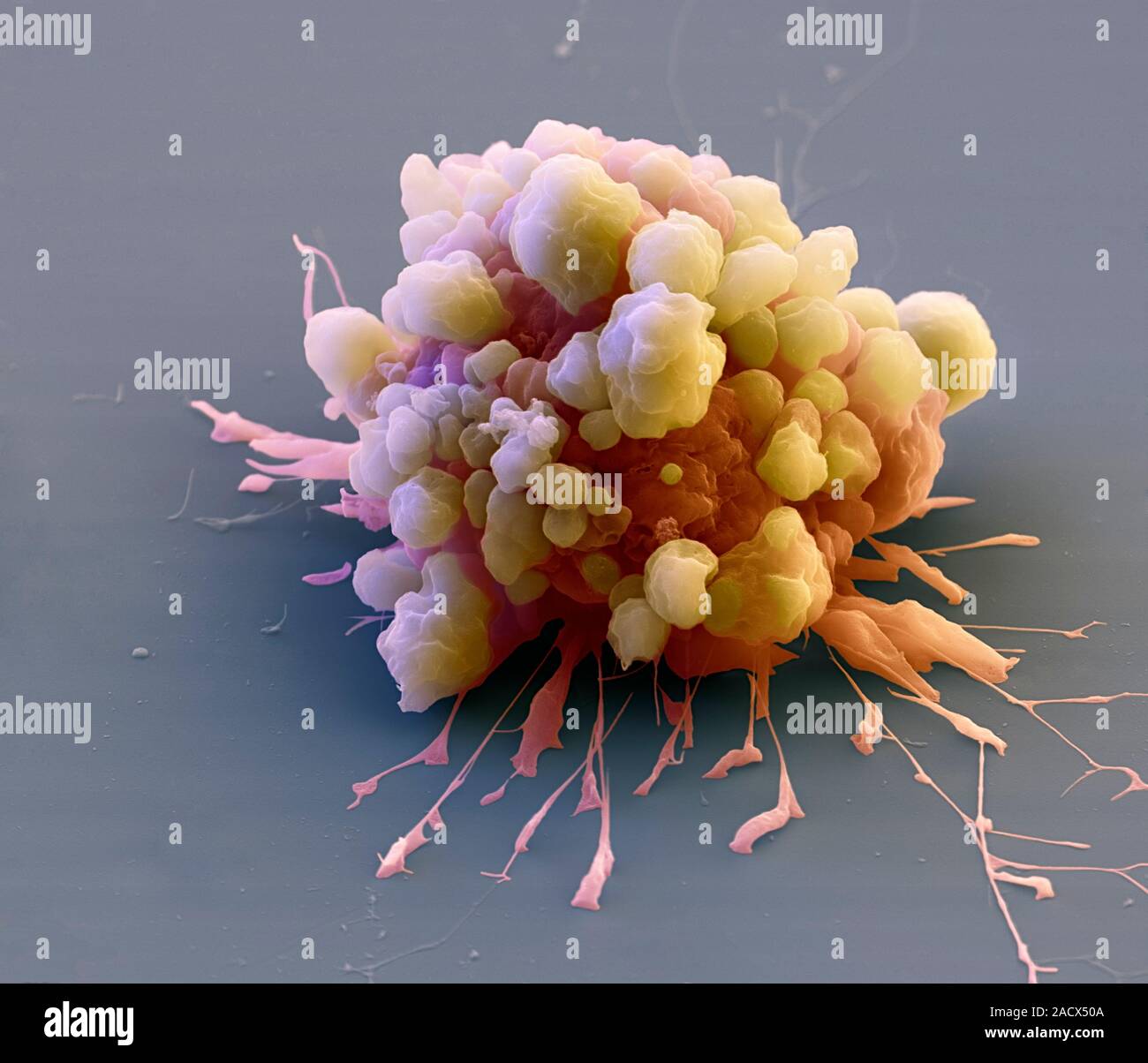 Apoptosis. Coloured scanning electron micrograph (SEM) of an ...