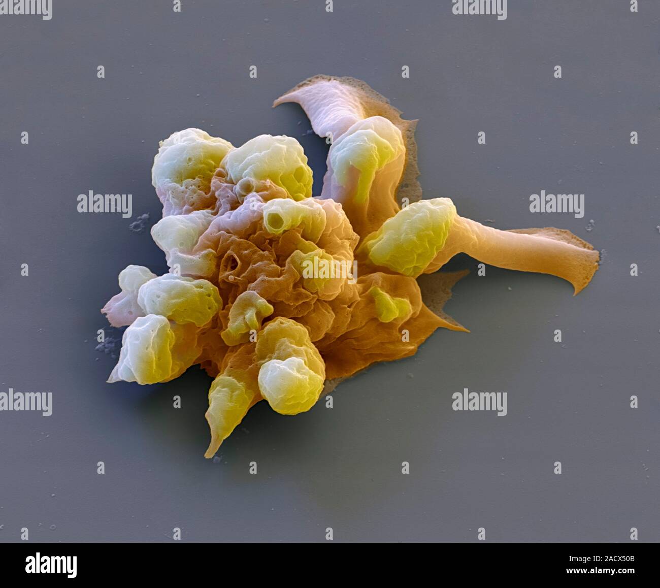 Apoptosis. Coloured scanning electron micrograph (SEM) of an ...