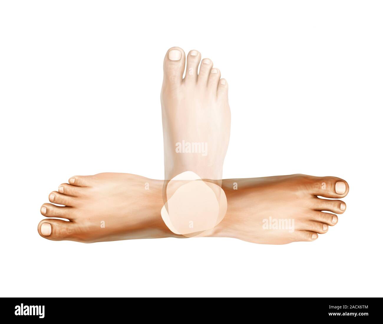 Illustration Of The Talipes Or Foot Deformations From The Anatomical
