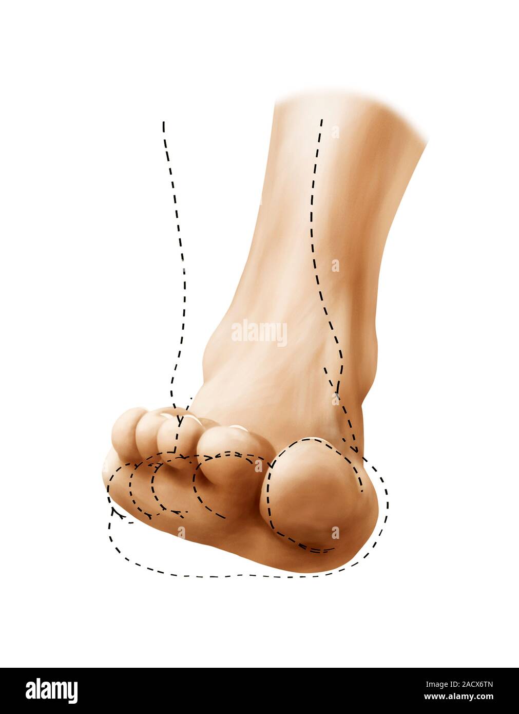Illustration Of The Talipes Or Foot Deformations From The Anatomical