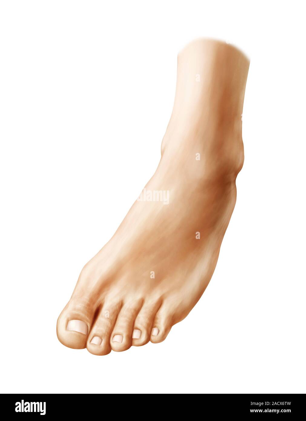Illustration Of The Talipes Or Foot Deformations From The Anatomical