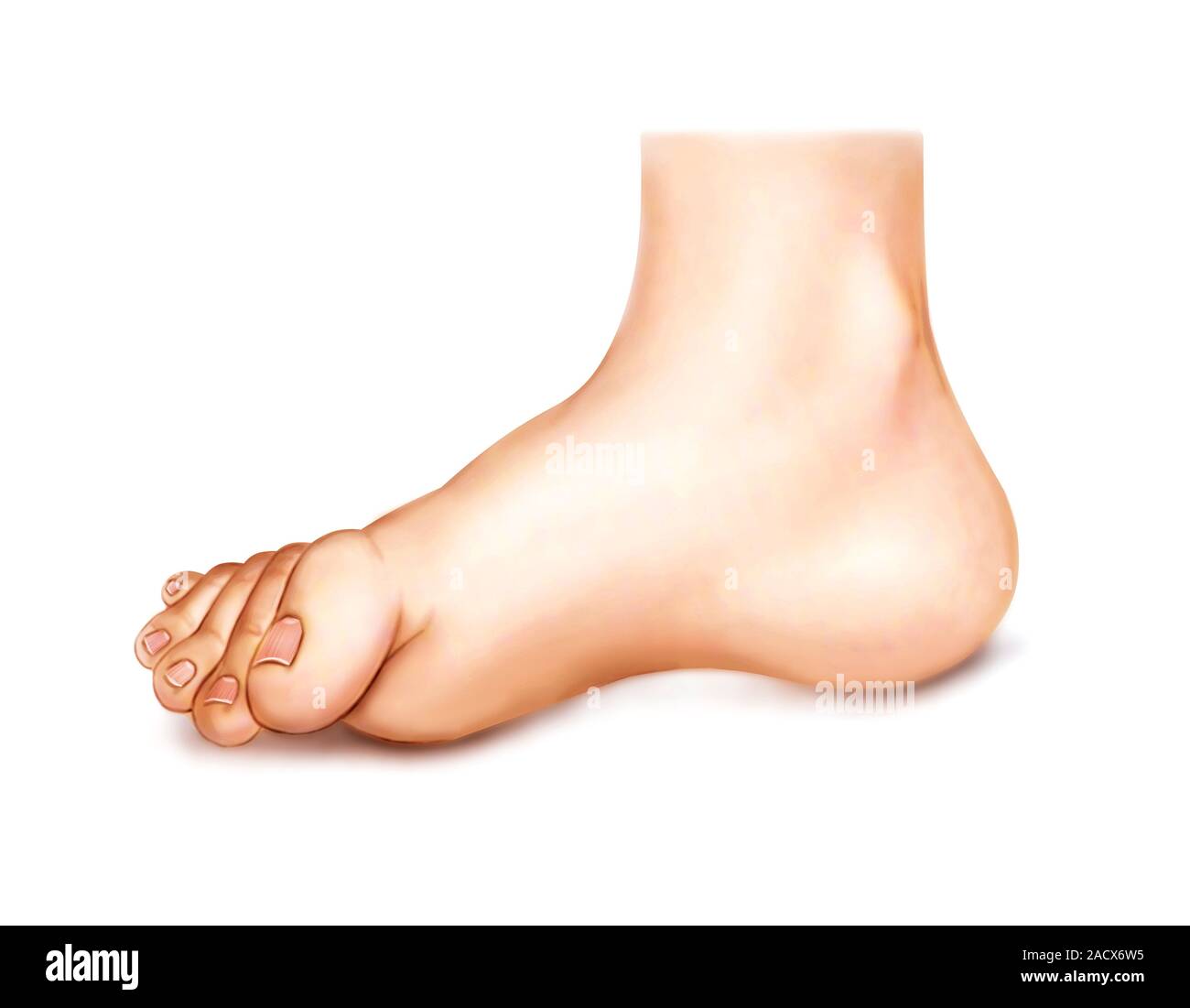 Illustration Of The Talipes Or Foot Deformations From The Anatomical
