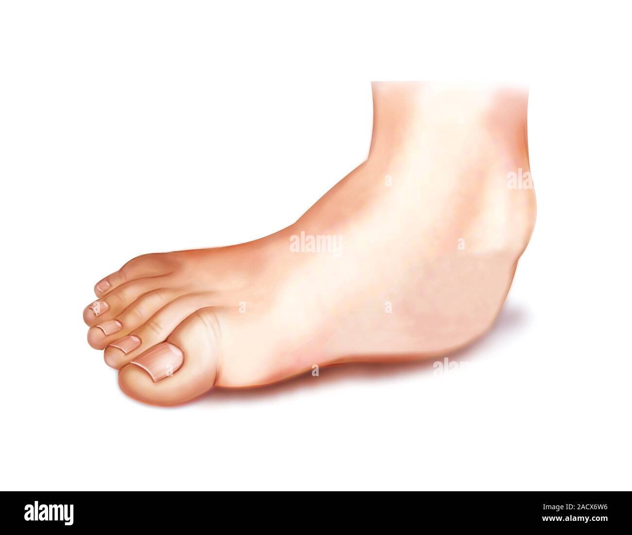 Illustration Of The Talipes Or Foot Deformations From The Anatomical