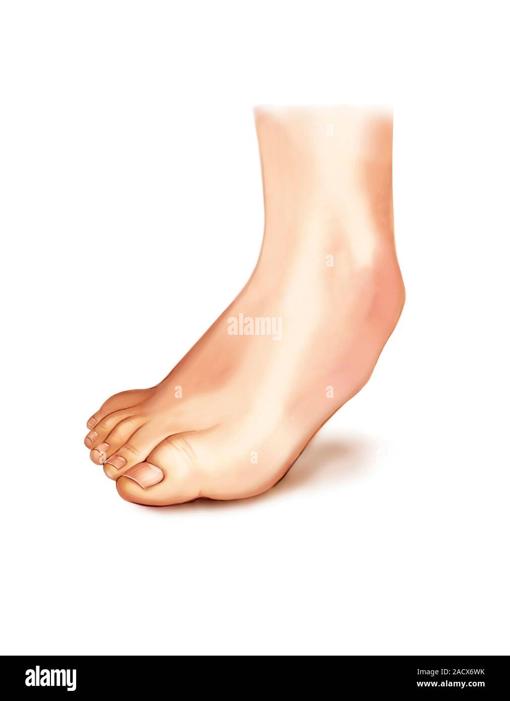Illustration Of The Talipes Or Foot Deformations From The Anatomical