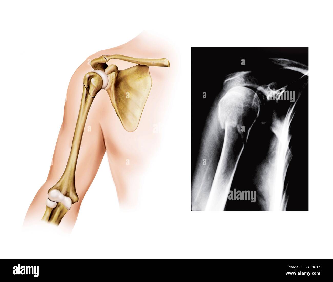 Illustration of the types of bone fractures, impacted fracture. This ...