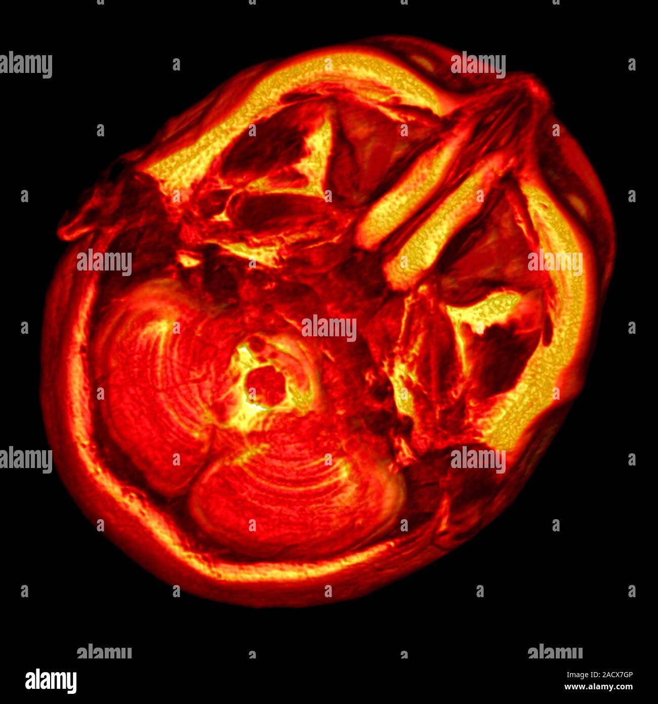 Coloured Magnetic Resonance Imaging (MRI) scan of a person's head with ...