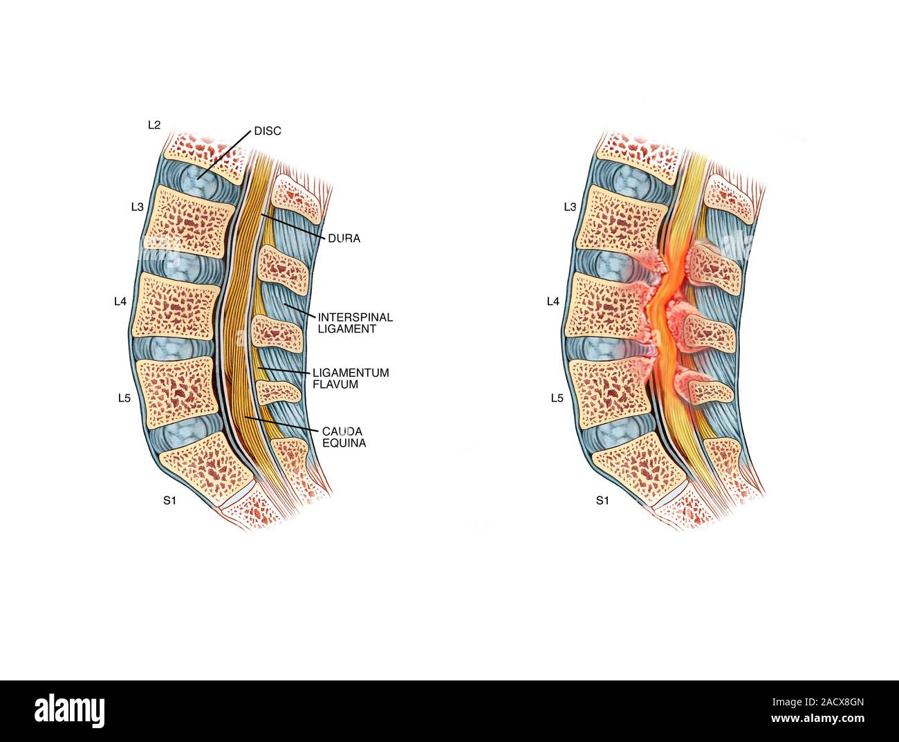 Nerve compression in lumbar stenosis. Labelled artworks of sagittal ...