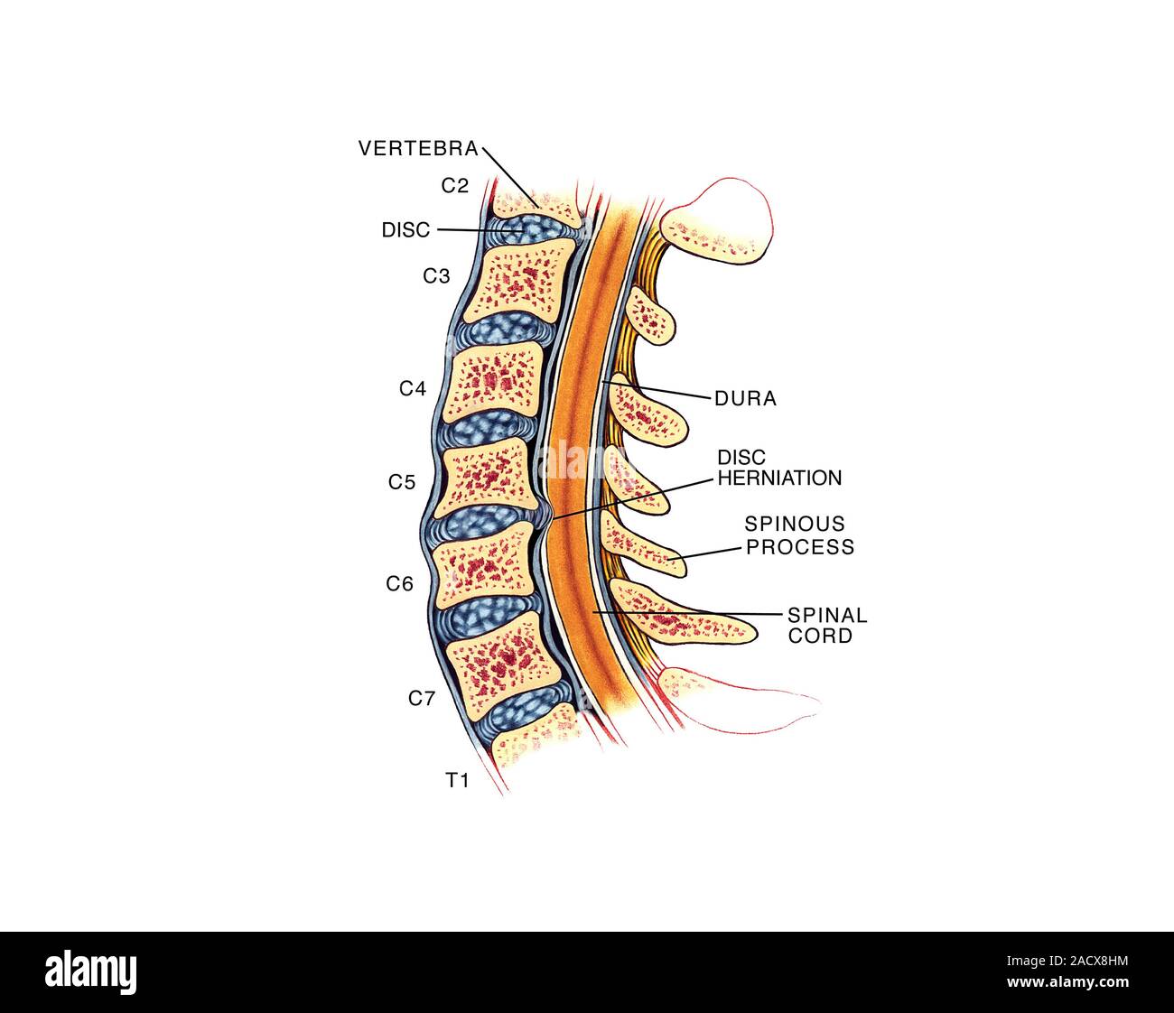 Slipped disc in the cervical spine. Labelled artwork of a sagittal ...