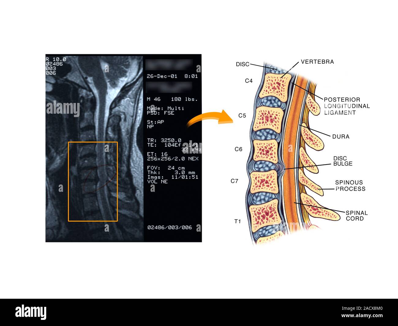 Bulging disc in the cervical spine. Labelled artwork and corresponding ...