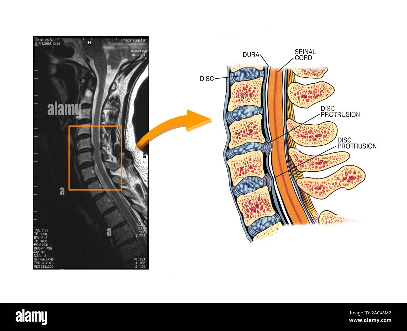 Protruding discs in the cervical spine. Labelled artwork and ...