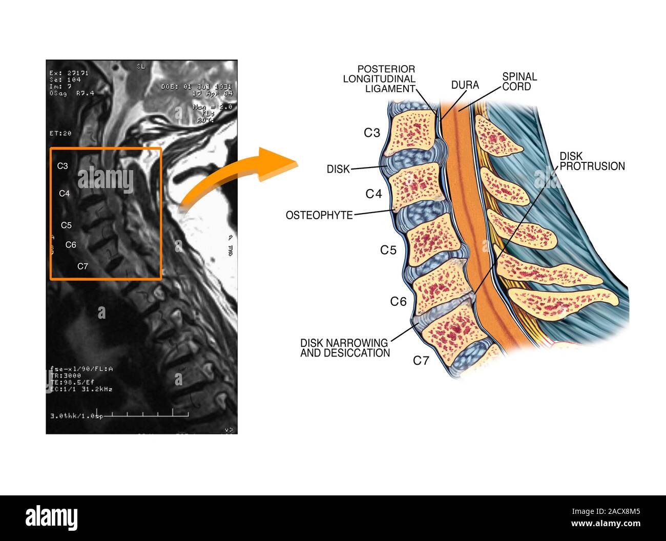 Protruding disc in the cervical spine. Labelled artwork and ...