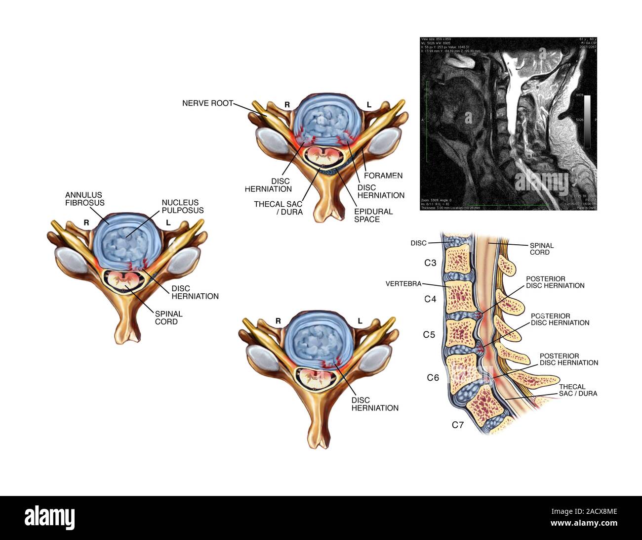 Slipped discs in the cervical spine. Labelled axial and sagittal ...
