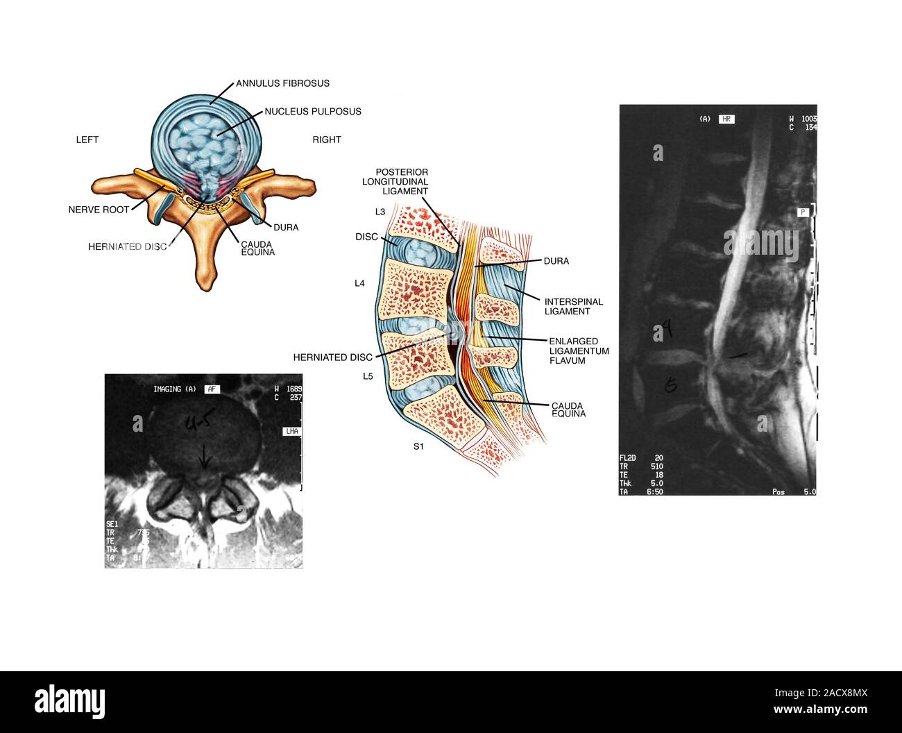 Slipped disc in the lumbar spine. Labelled axial (left) and sagittal ...