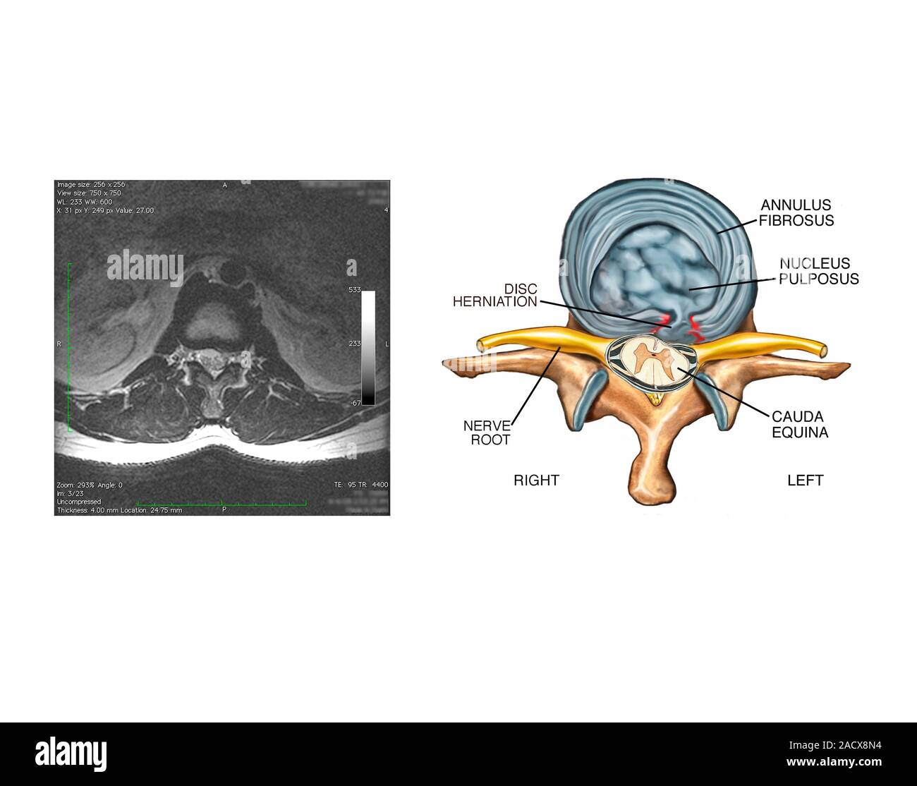 Slipped disc in the lumbar spine. Labelled artwork and corresponding ...