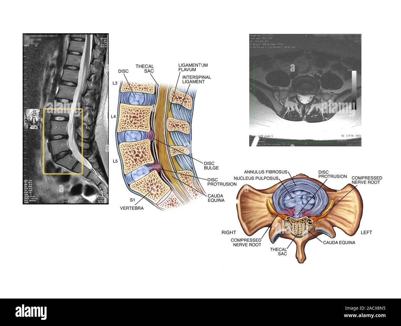 Slipped discs in the lumbar spine. Labelled artworks and corresponding ...