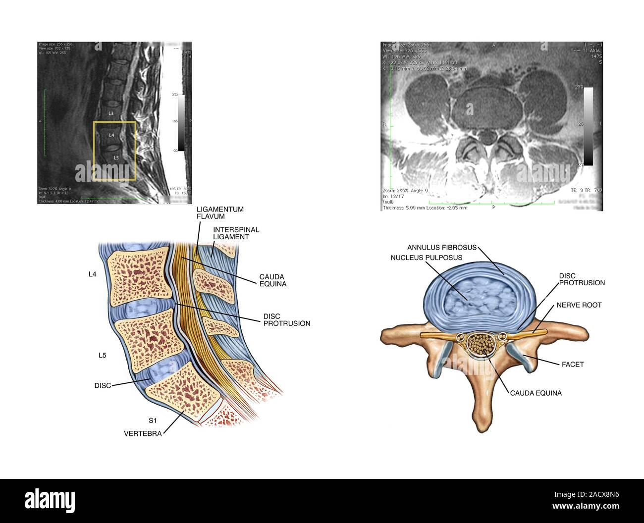 Protruding disc in the lumbar spine. Labelled artworks and ...