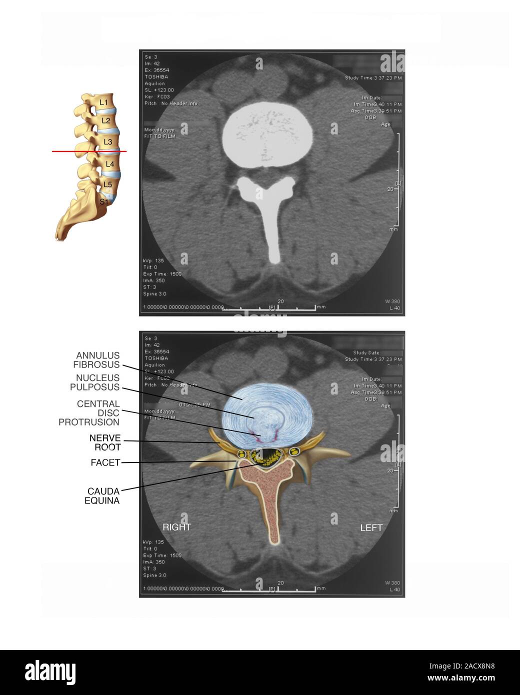 Protruding disc in the lumbar spine. Artwork and axial CT (computed ...