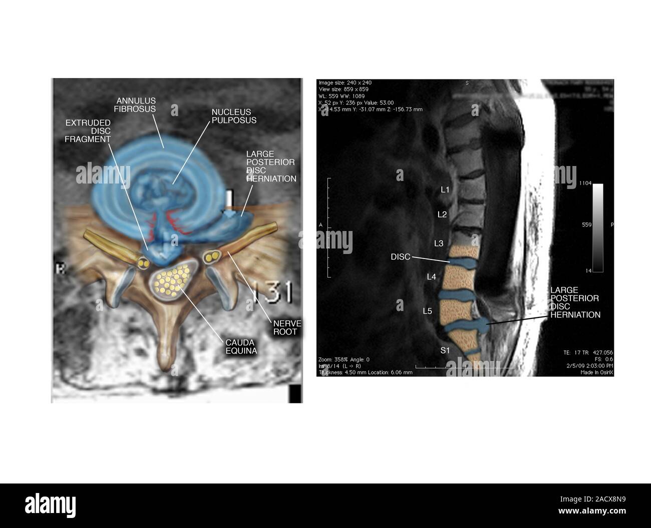 Slipped disc in the lumbar spine. Combined artworks and MRI (magnetic ...