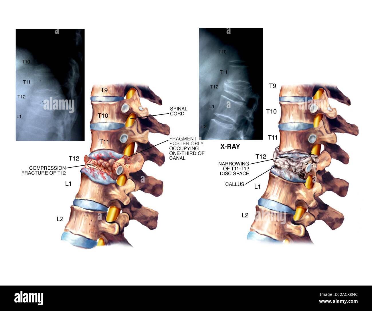 Compression fracture of thoracic vertebra. Labelled artworks and ...