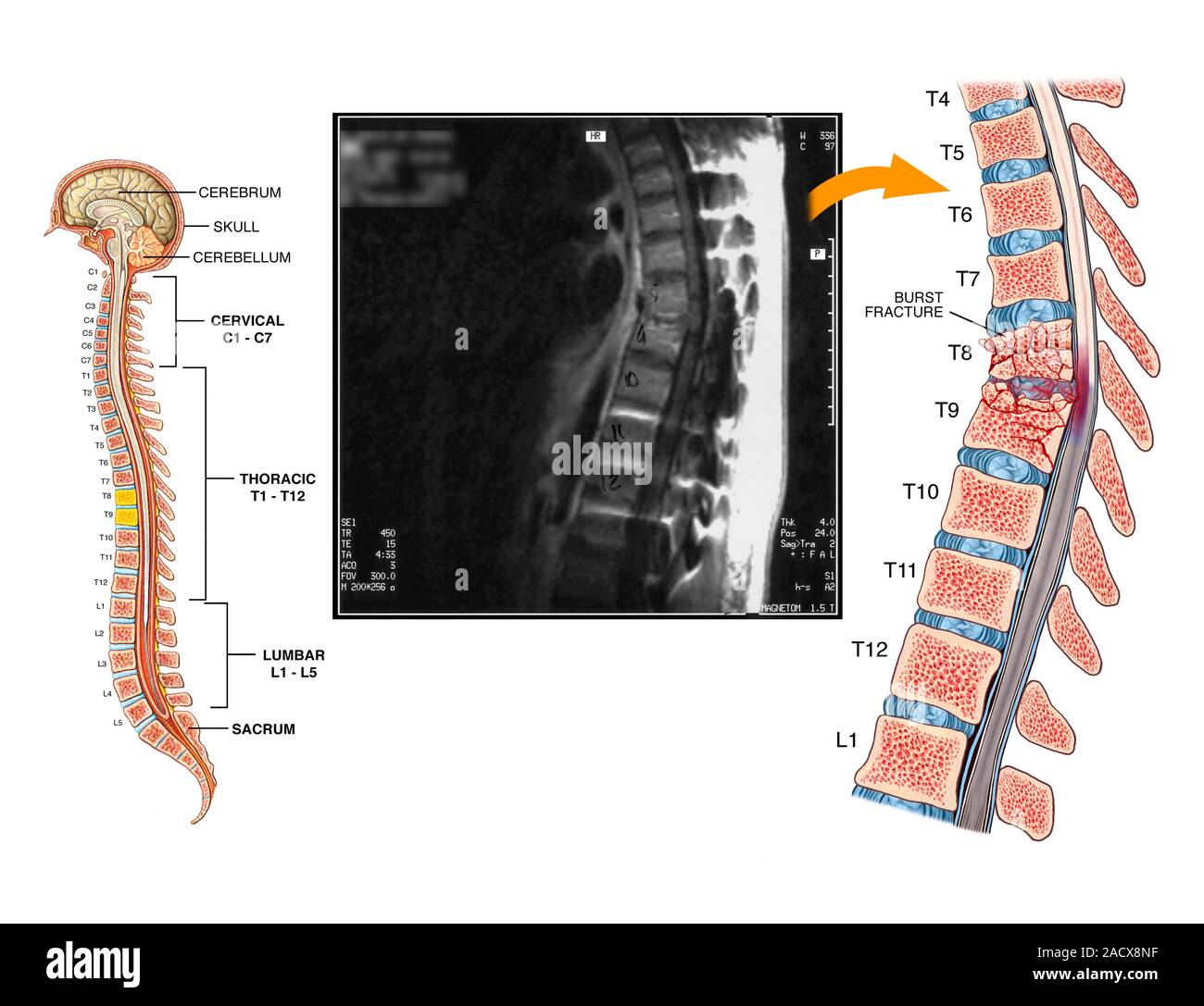 Burst fractures of the thoracic spine. Labelled artworks and ...