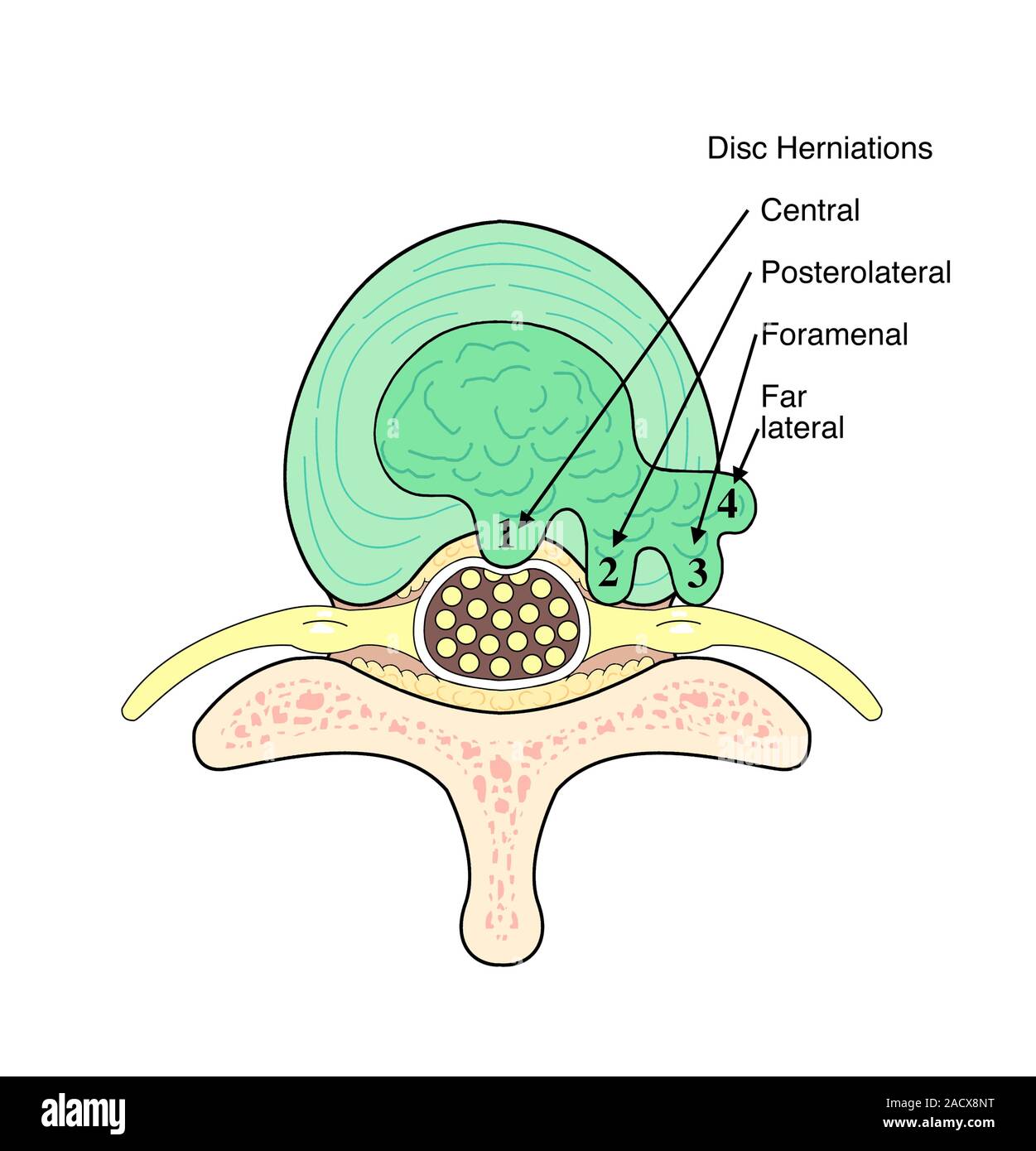 Types of herniated intervertebral discs. Artwork of an axial view of a ...