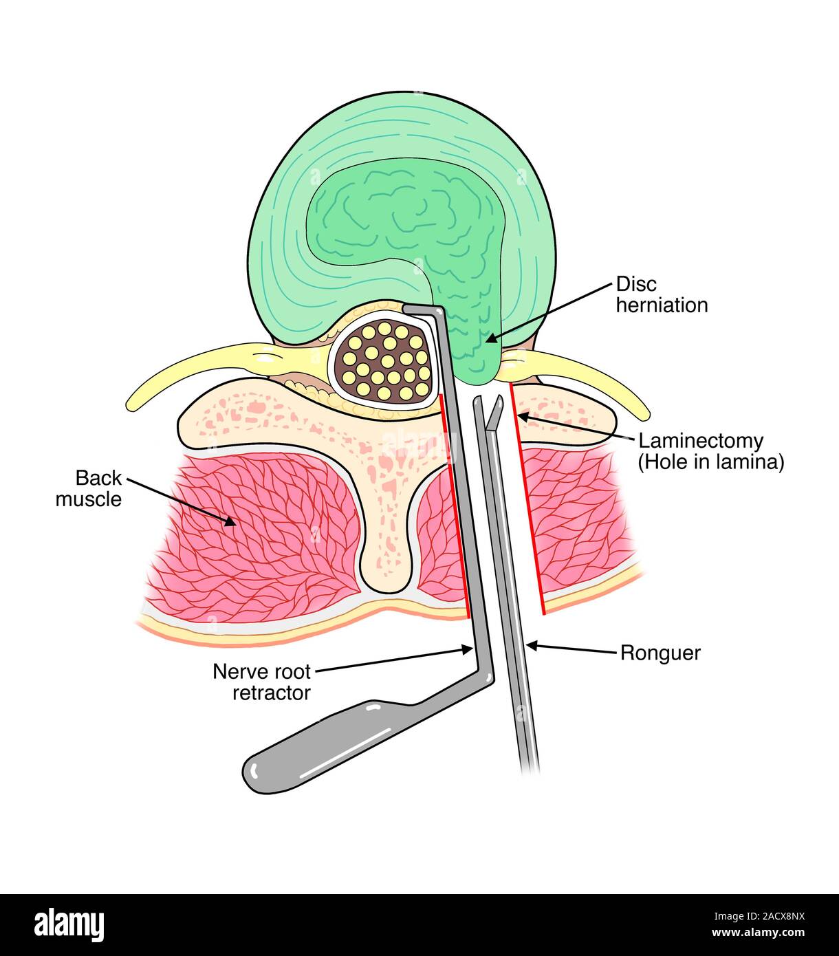 Prolapsed Disc Surgery