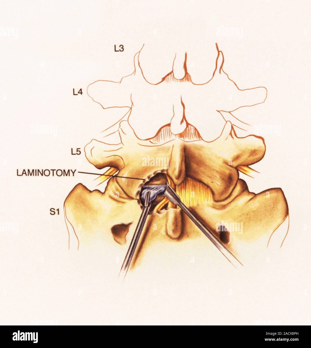 Laminotomy surgery on slipped disc. Labelled artwork of a posterior ...