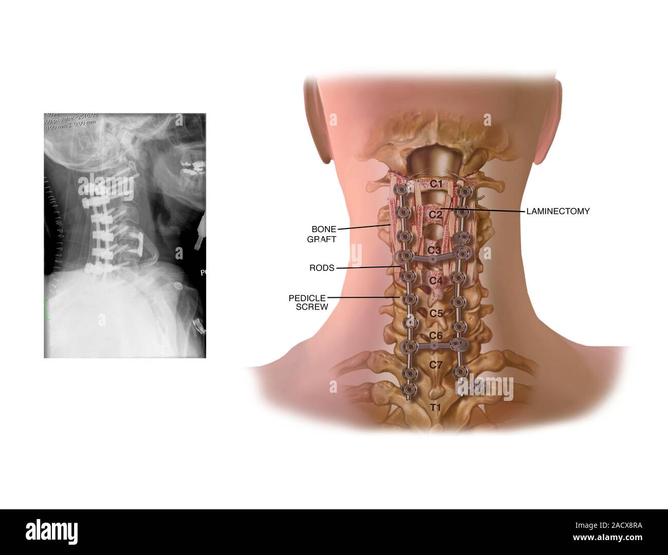 Surgery to fuse the cervical spine. Labelled artwork of a posterior ...