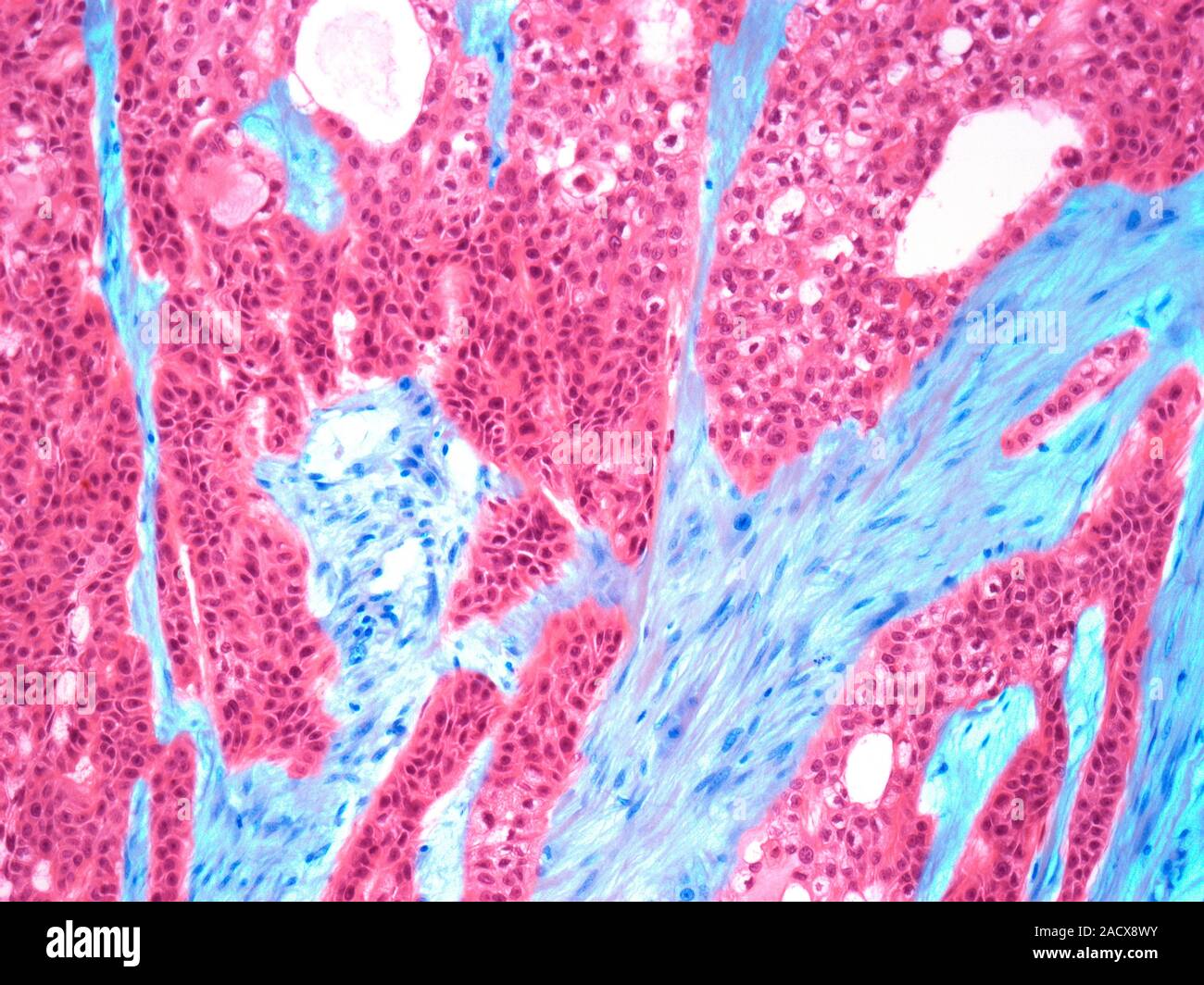 Sebaceous carcinoma of the scalp, light micrograph of a section of ...