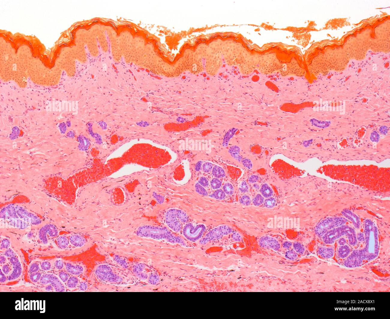 Myelomeningocele sac, light microscopy of the outer wall of the sac ...