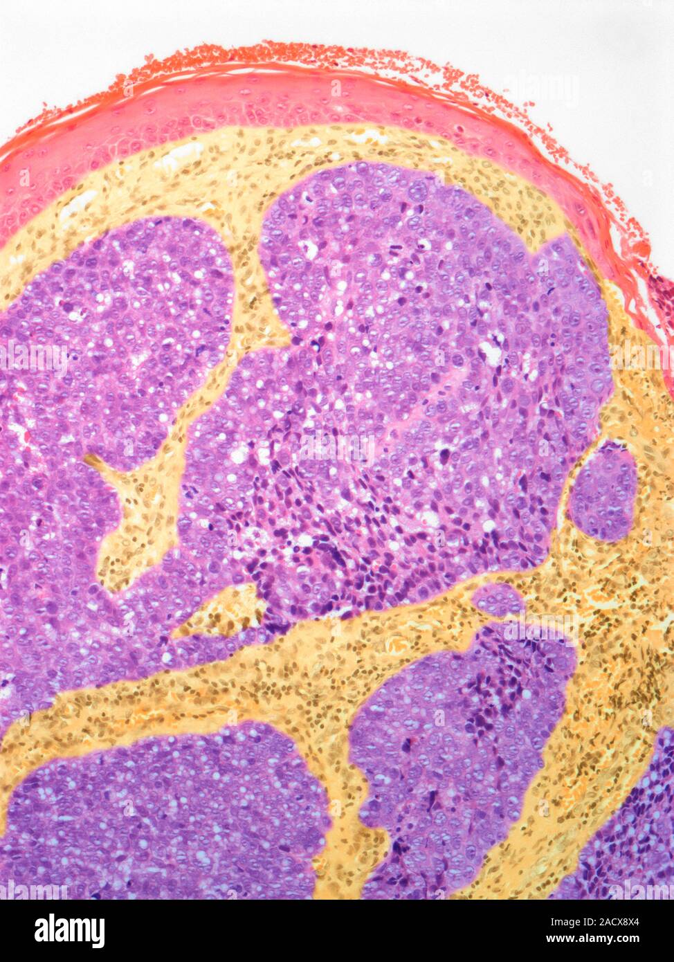 Sebaceous carcinoma of the eyelid, light micrograph of a section of ...