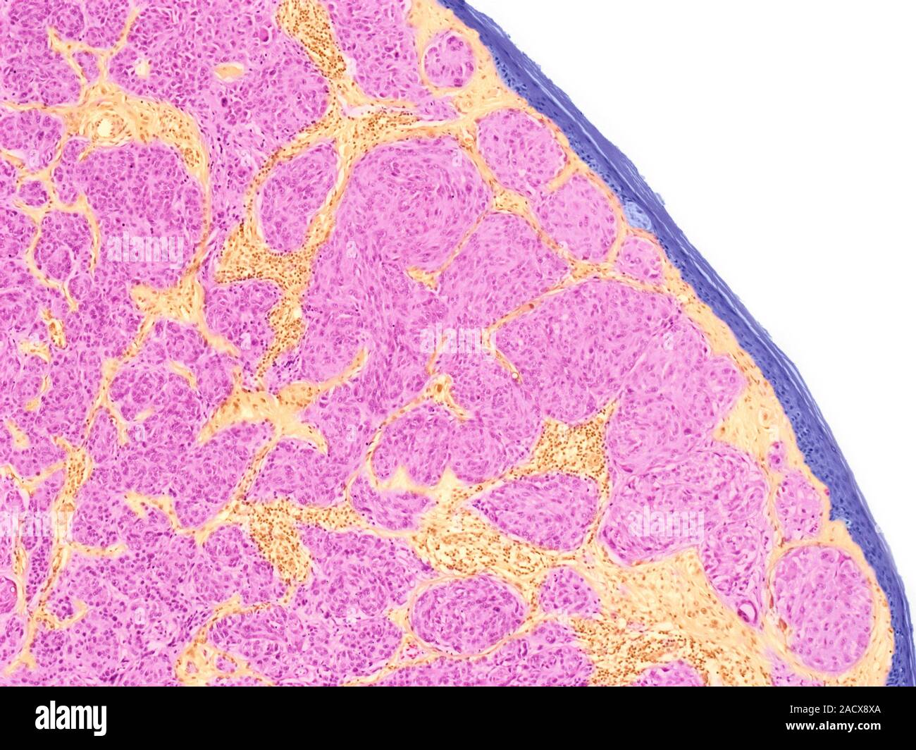 Spitz nevus, light micrograph section of affected skin from a four year ...