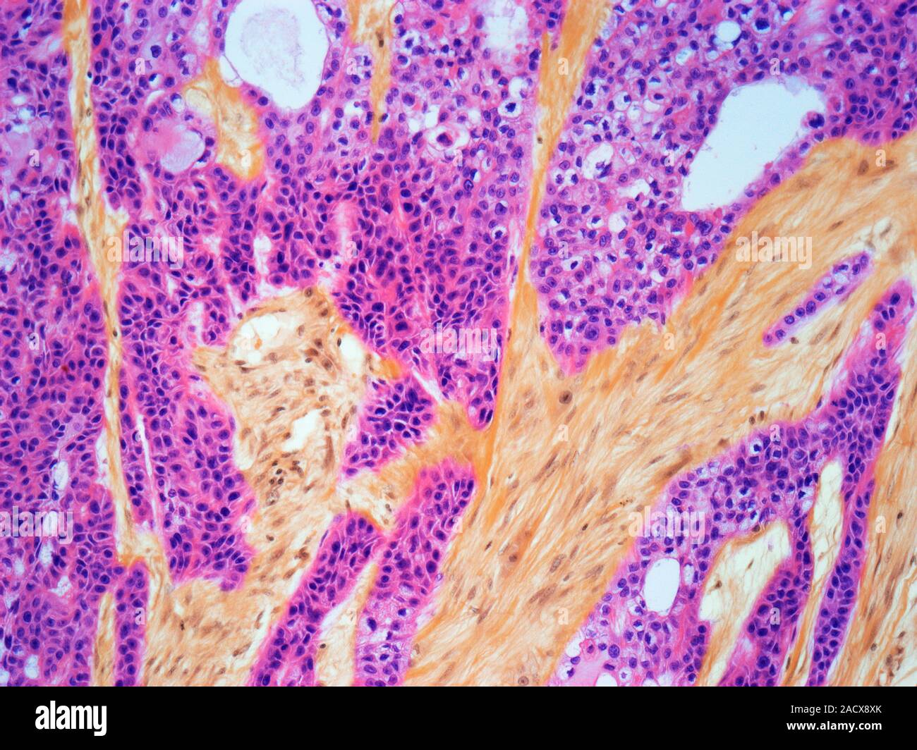Sebaceous carcinoma of the scalp, light micrograph of a section of ...