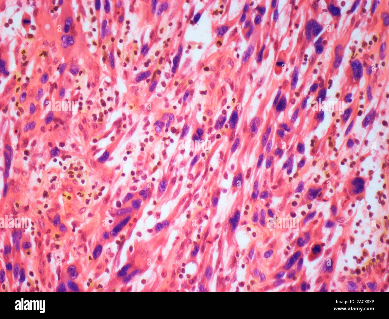 Spindle cell carcinoma of the pharynx, light micrograph of a section of ...