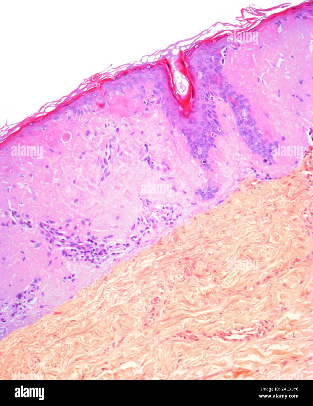 Juvenile colloid milium, light micrograph of a skin section. In this ...
