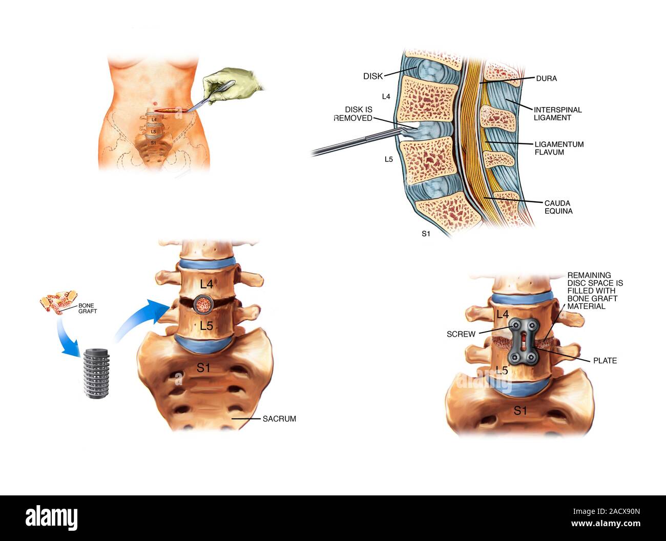 Surgery to fuse the lumbar spine. Sequence of artworks of an operation ...